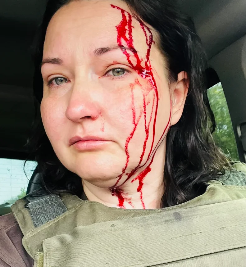 Найстрашніші поранення на фронті - парамедикиня розповіла про лякаючі ...