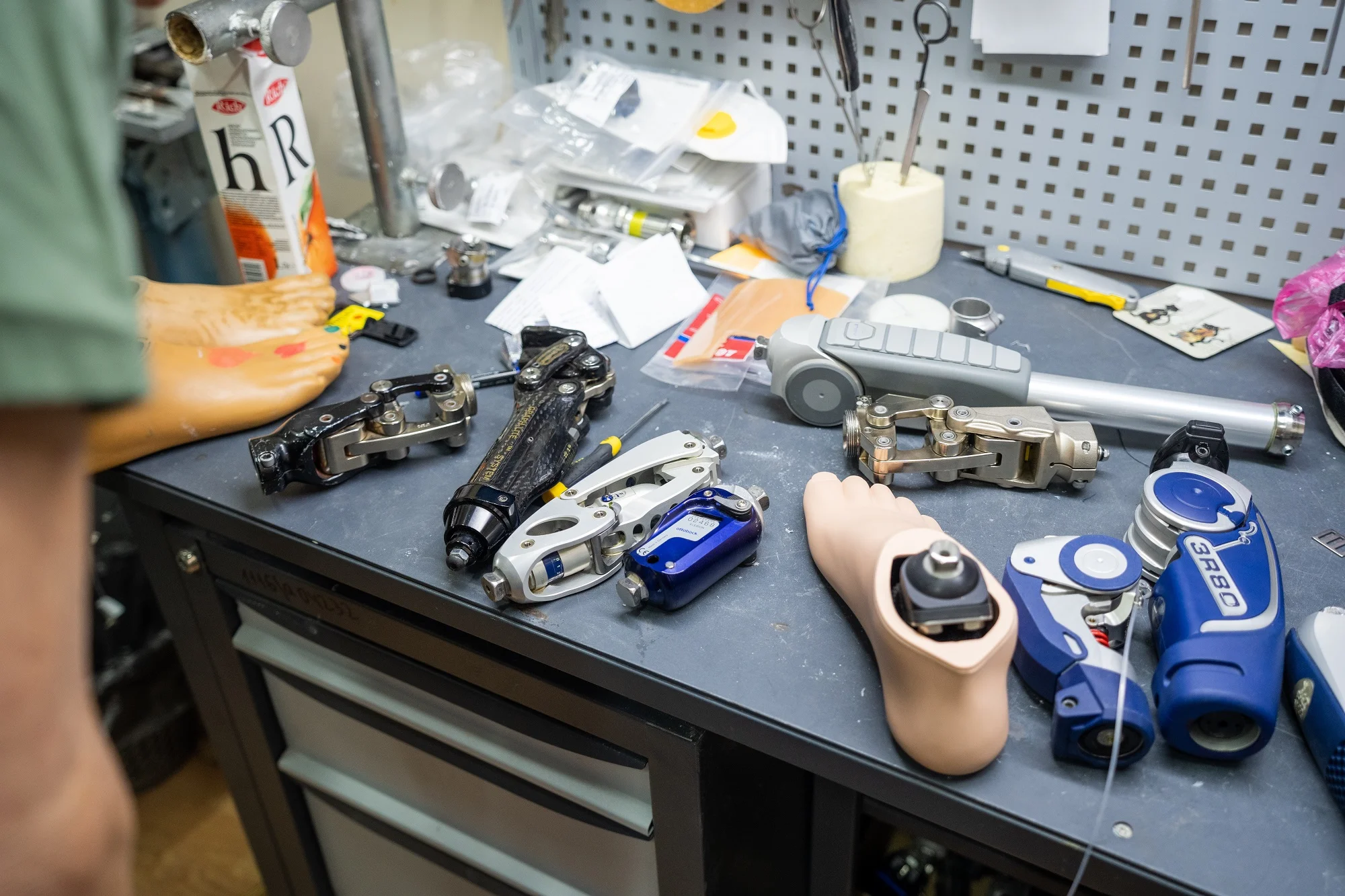 Ампутація в Україні ― які фахівці допомагають постраждалим та що потрібно знати про підготовку / NV